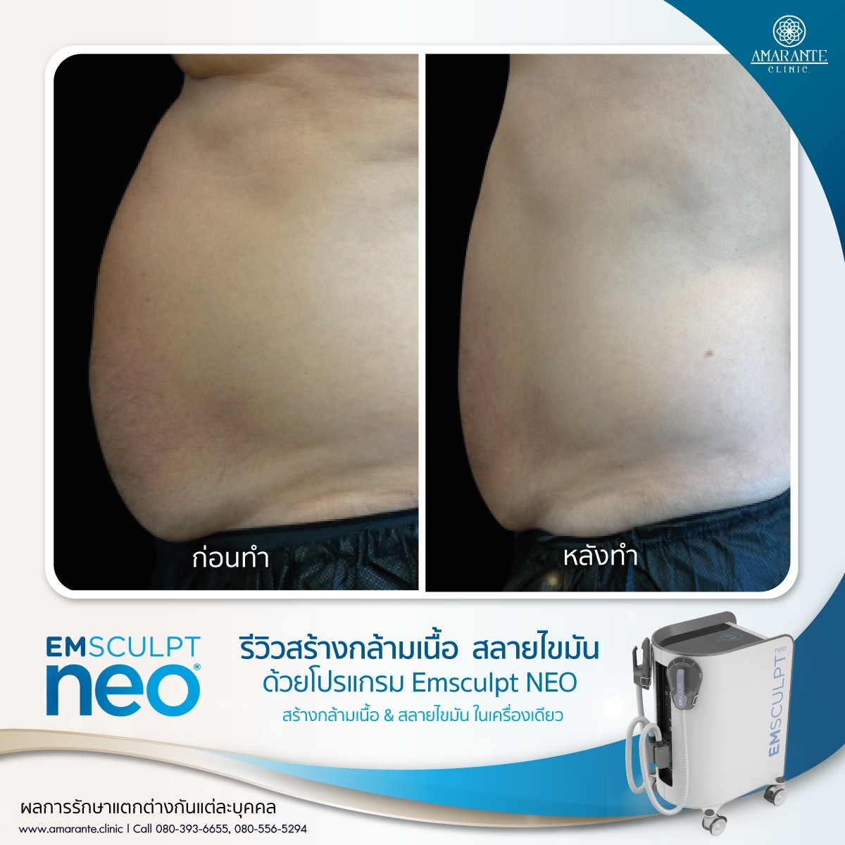 แก้ท้องย้วยหลังคลอด ด้วย Emsculpt Neo ของคุณ ไอซ์ พาดี้