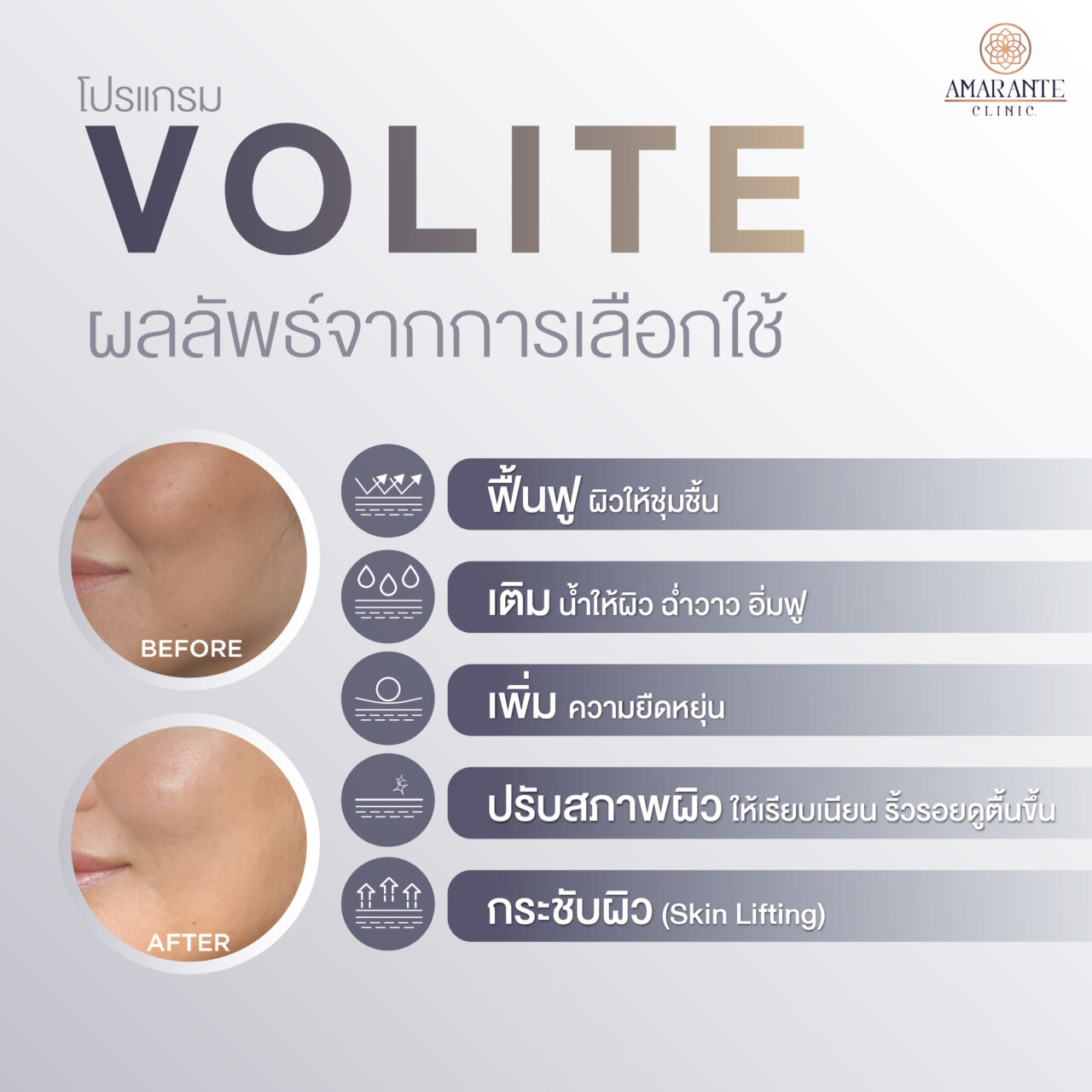 รวมข้อมูล Juvederm Volite เหมาะกับใคร? ราคาเท่าไหร่?