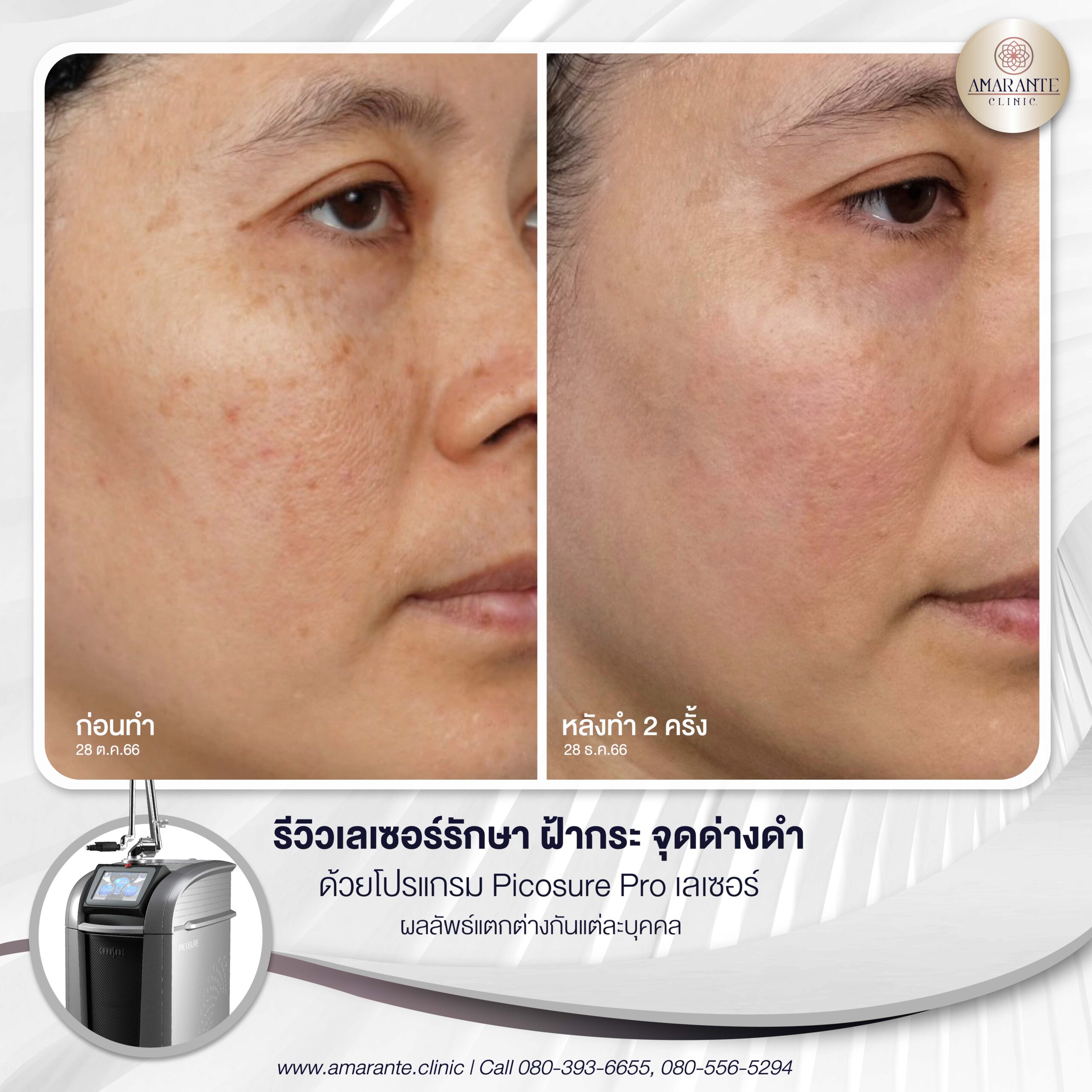 picosure pro เลเซอร์ vs picosure เลเซอร์